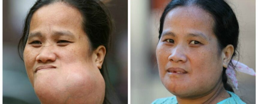 Here's How Australian Surgeons Removed a Massive Tumour From This Woman ...
