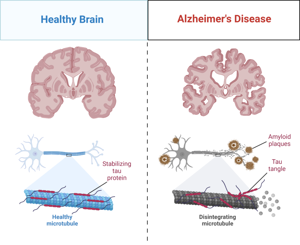 Aging Doesn't Cause Alzheimer's—Energy Failure in Brain Cells Does